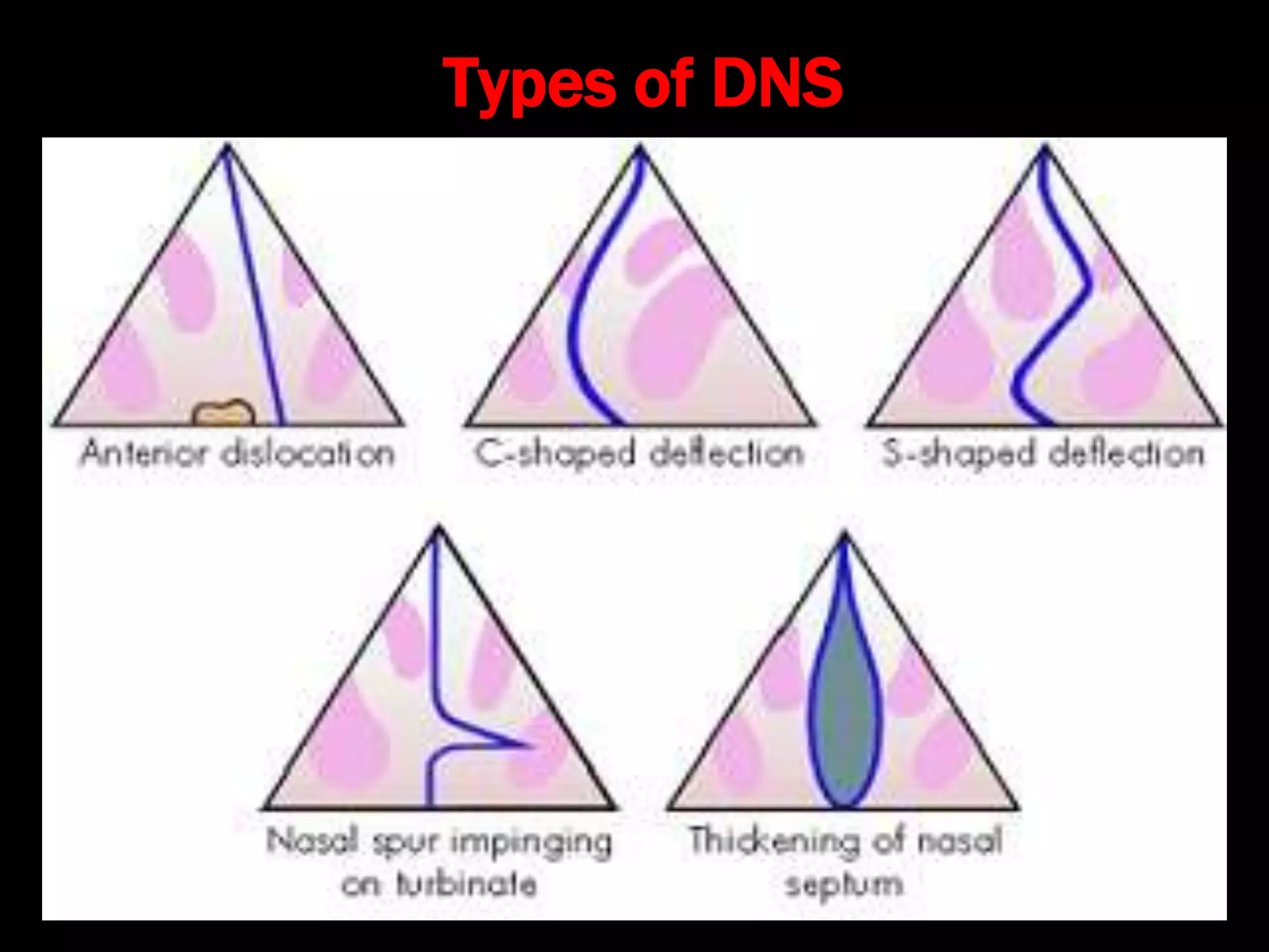 Deviated nasal septum and other septal conditions | PPT