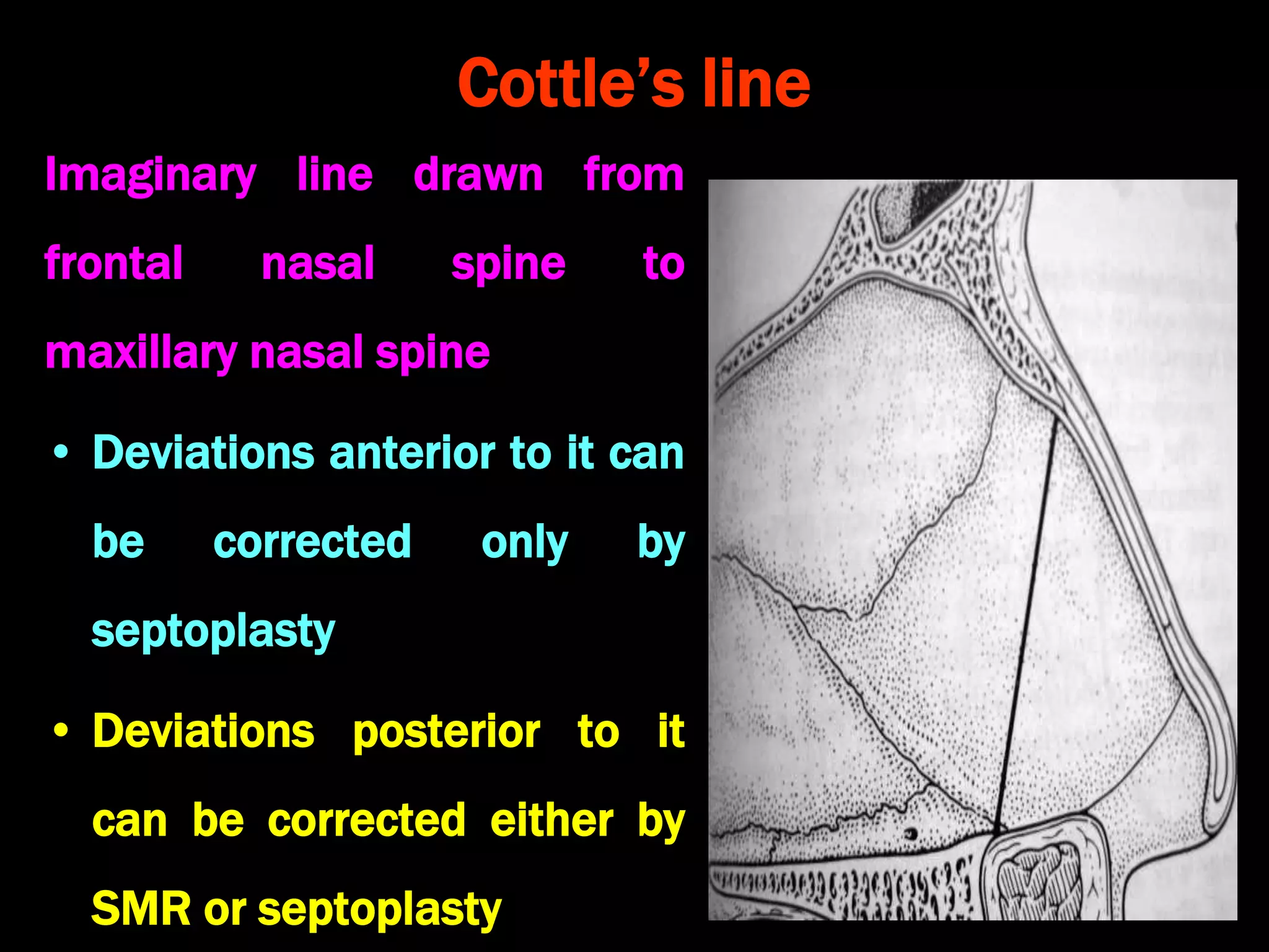 Deviated nasal septum and other septal conditions | PPT