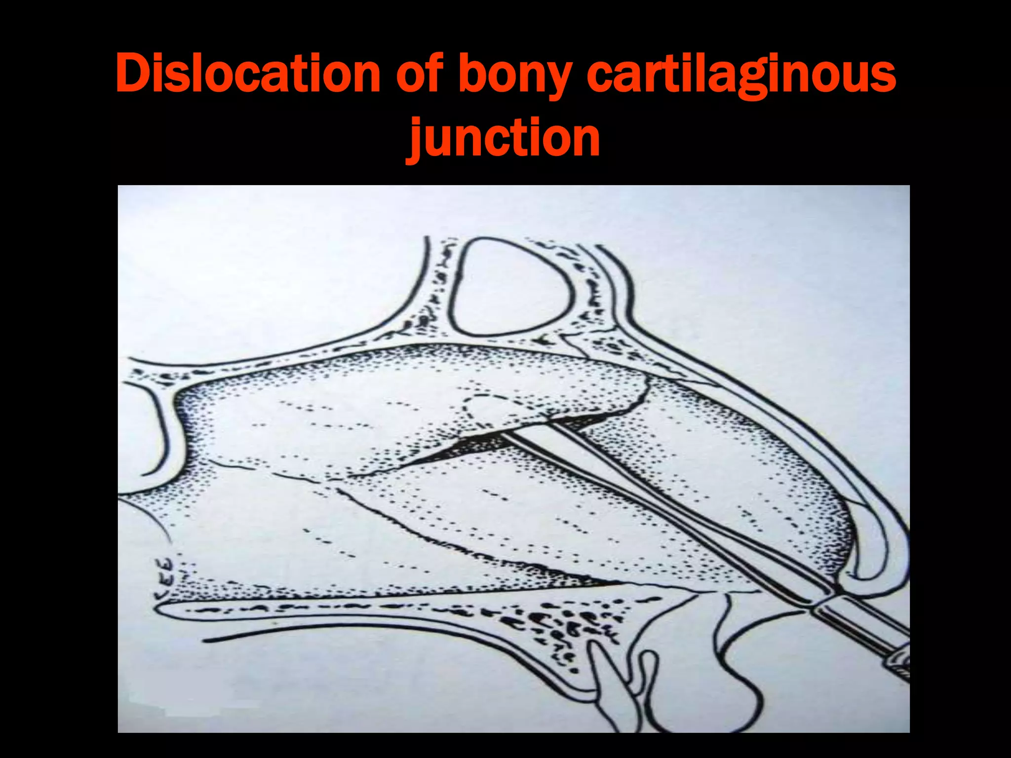 Deviated nasal septum and other septal conditions | PPT