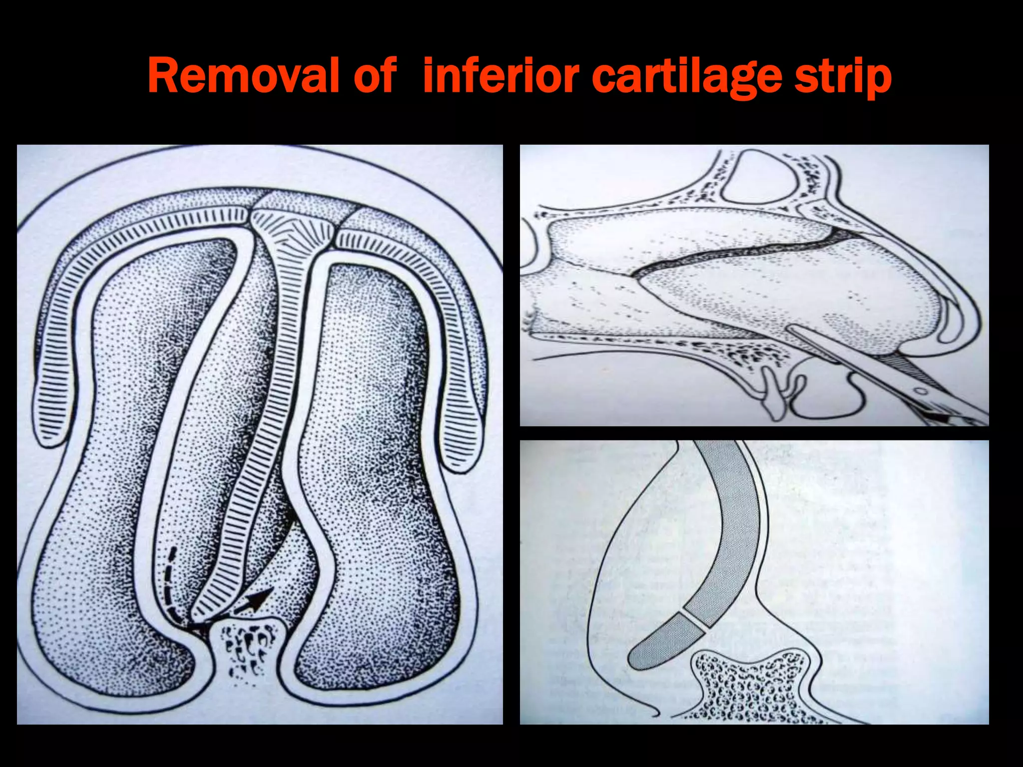Deviated nasal septum and other septal conditions | PPT