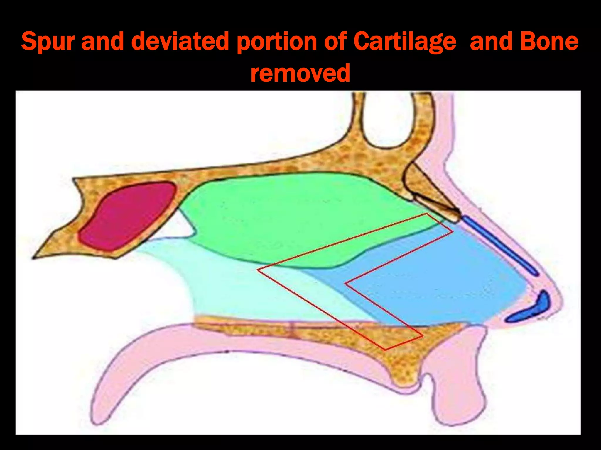 Deviated nasal septum and other septal conditions | PPT