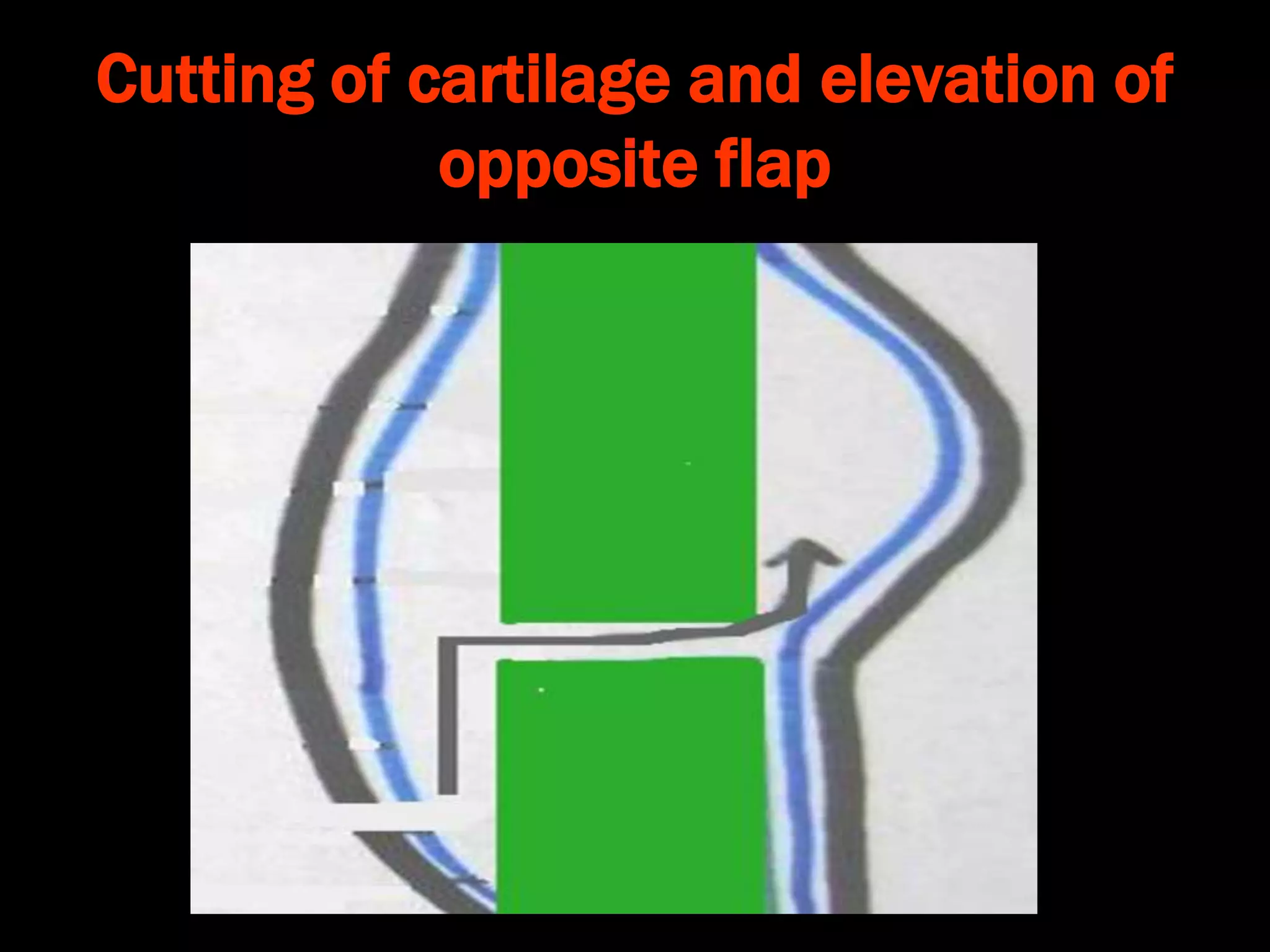 Deviated nasal septum and other septal conditions | PPT
