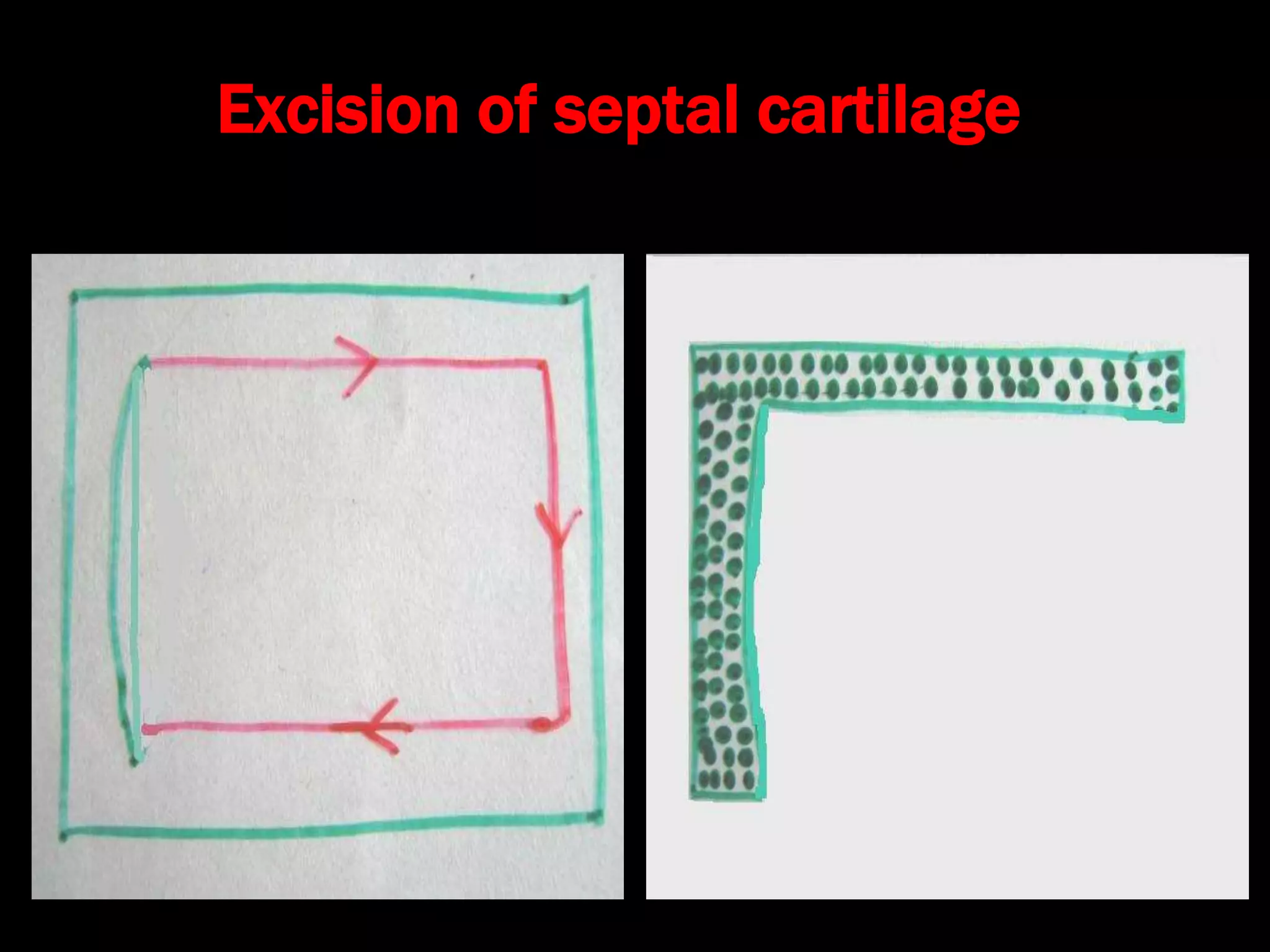 Deviated nasal septum and other septal conditions | PPT