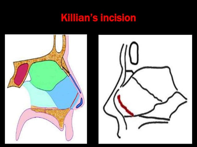 Deviated nasal septum and other septal conditions | PPT