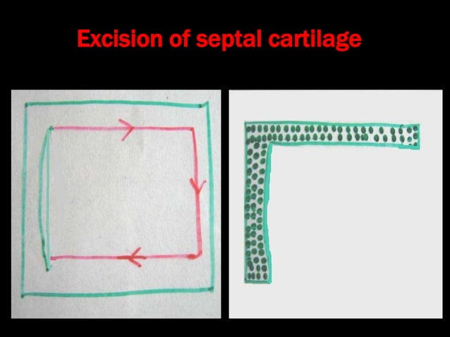 Deviated nasal septum and other septal conditions | PPT