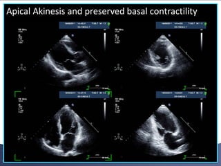 Device Based Approaches For Heart Failure Ventricular Reshaping | PPT