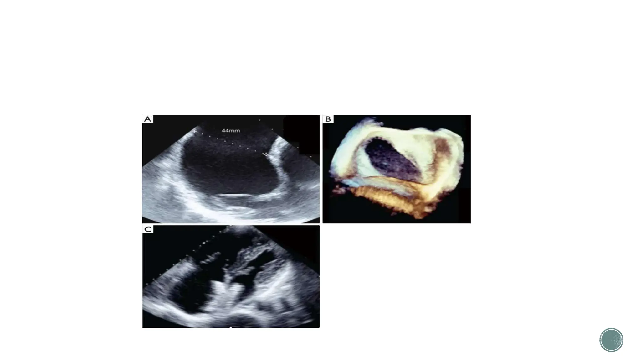 Cardiac catheterization DEVICE CLOSURE OF ASD.pptx