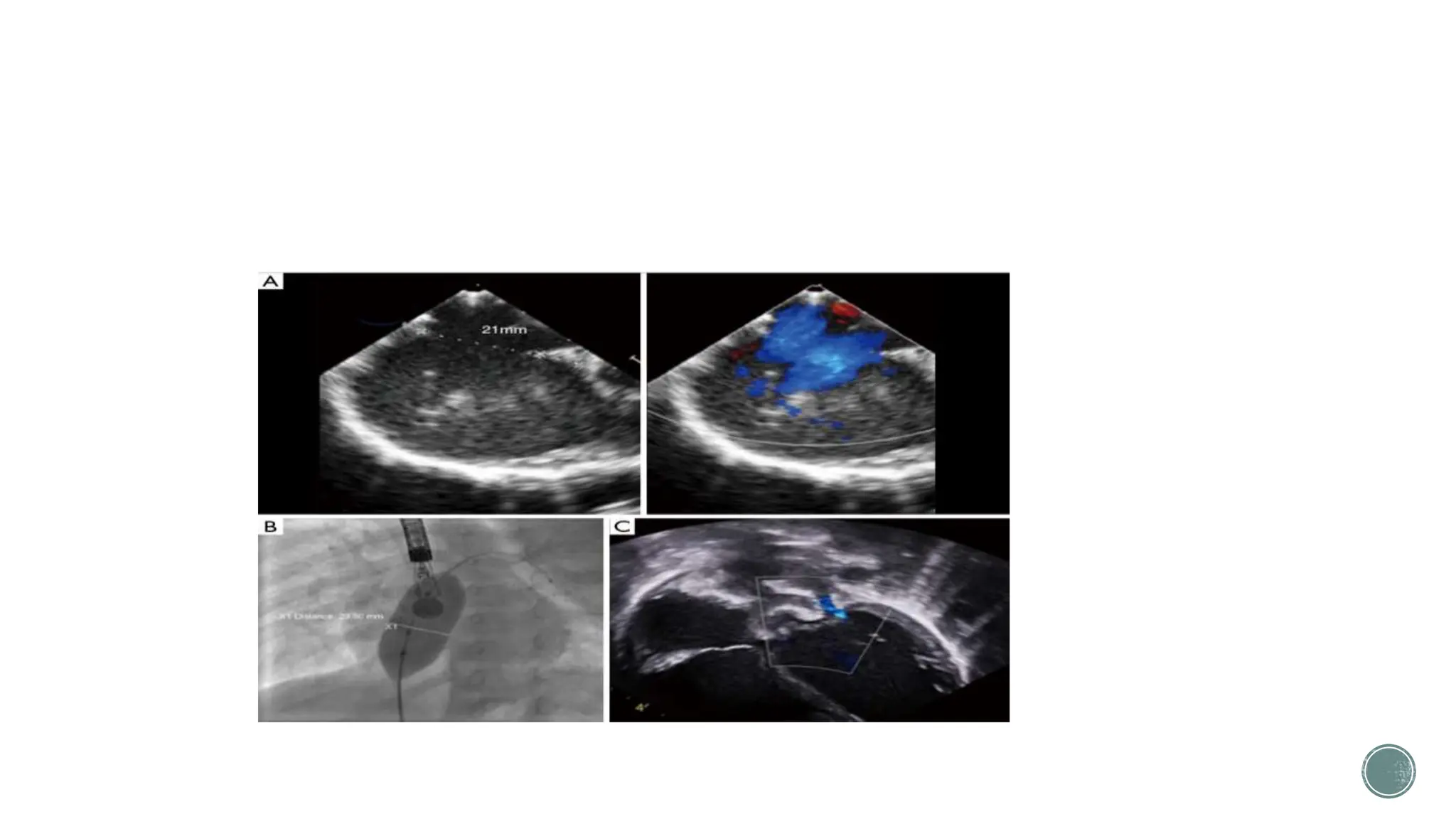 Cardiac catheterization DEVICE CLOSURE OF ASD.pptx