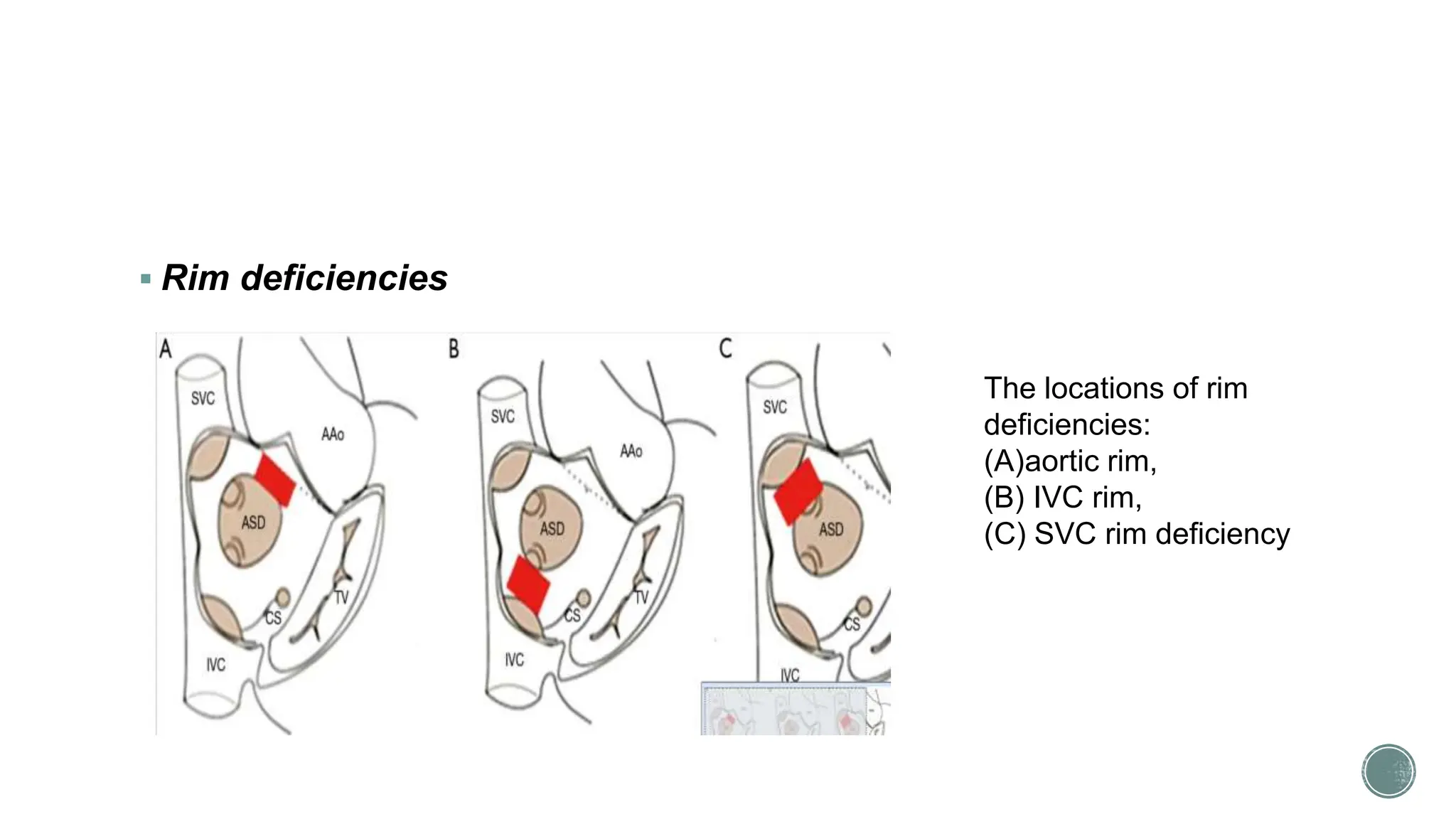 Cardiac catheterization DEVICE CLOSURE OF ASD.pptx