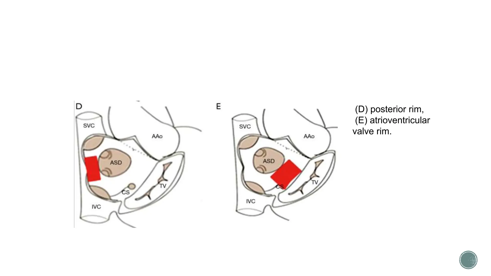 Cardiac Catheterization Device Closure Of Asd Pptx
