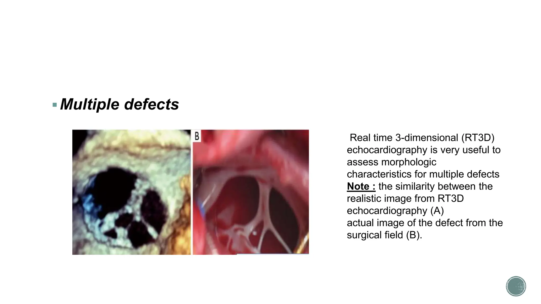 Cardiac catheterization DEVICE CLOSURE OF ASD.pptx