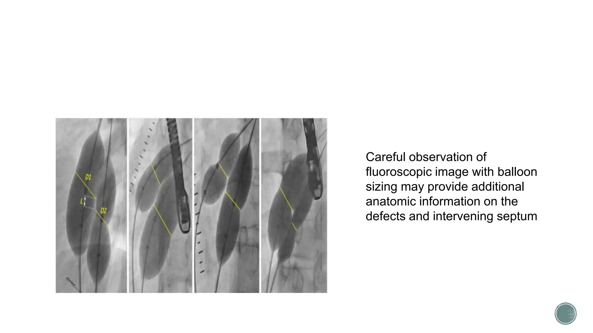 Cardiac Catheterization Device Closure Of Asd Pptx