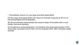 Cardiac catheterization DEVICE CLOSURE OF ASD.pptx