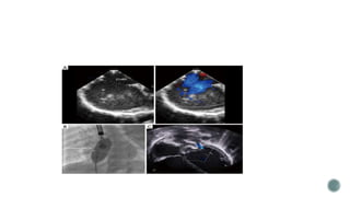 Cardiac catheterization DEVICE CLOSURE OF ASD.pptx