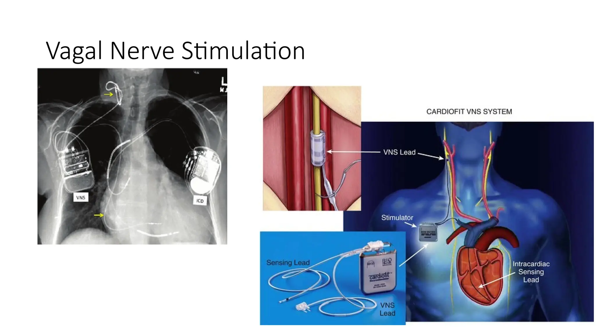 DEVICE THERAPY IN HEART FAILURE latest advances.pptx