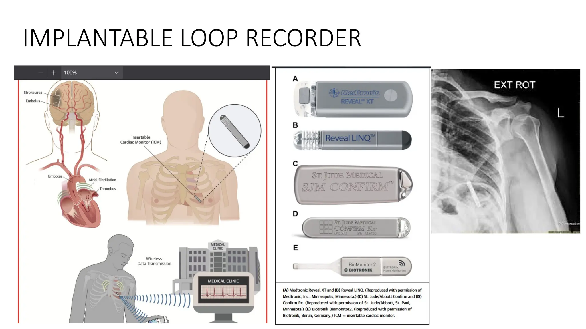 DEVICE THERAPY IN HEART FAILURE latest advances.pptx
