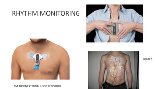 DEVICE THERAPY IN HEART FAILURE latest advances.pptx