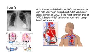 DEVICE THERAPY IN HEART FAILURE.pptx summary | PPTX
