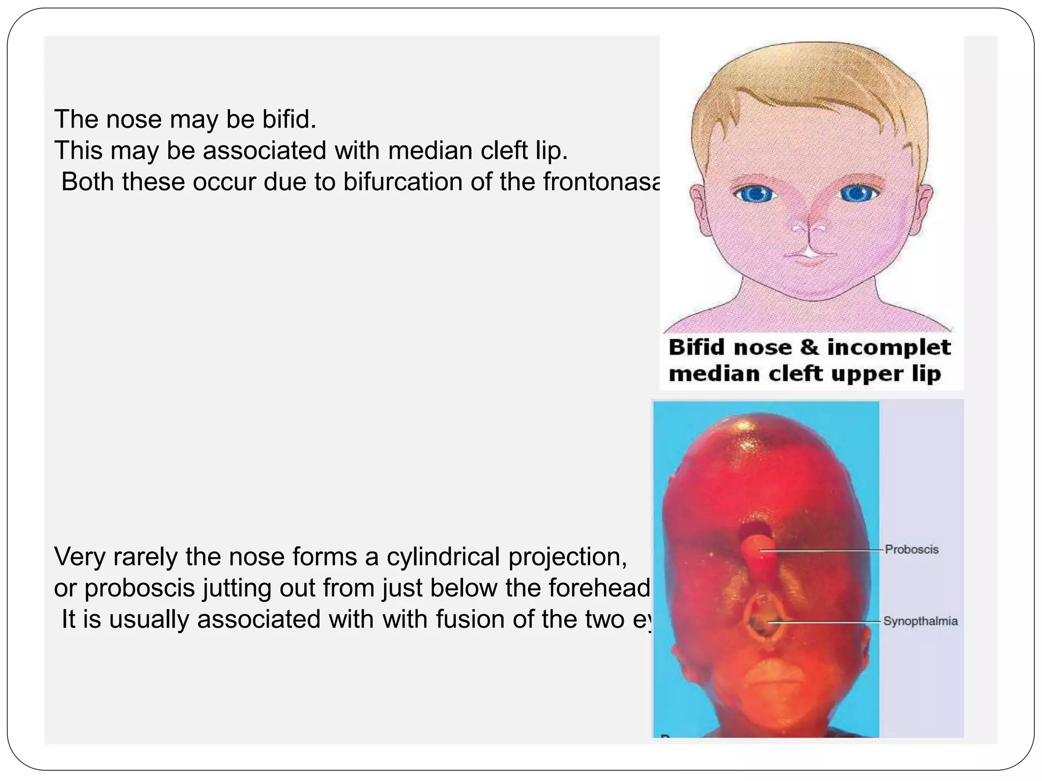 Devlopment of face and its abnormalites | PPTX