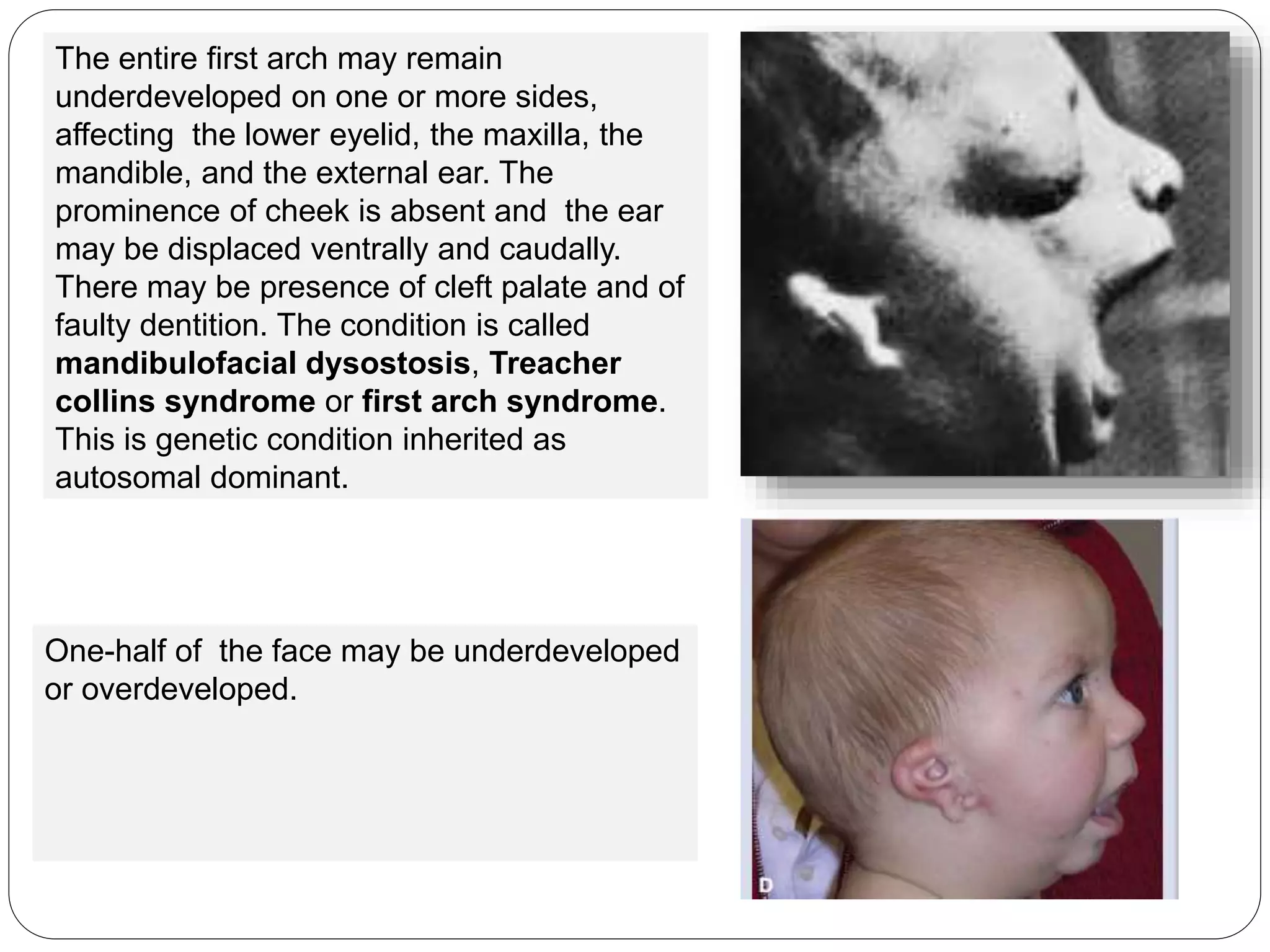 Devlopment of face and its abnormalites | PPTX