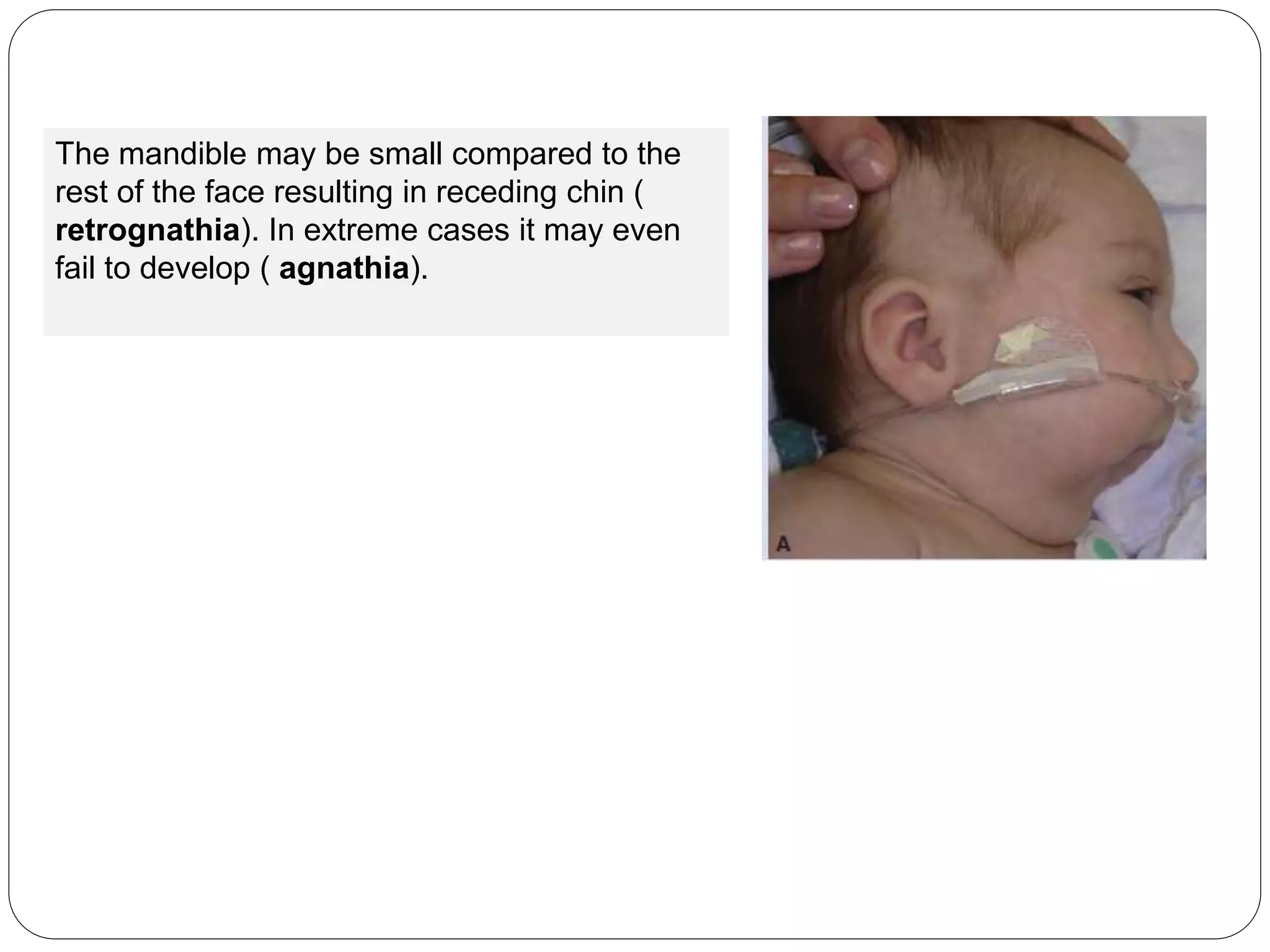 Devlopment of face and its abnormalites | PPTX