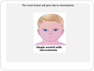 Devlopment of face and its abnormalites | PPTX