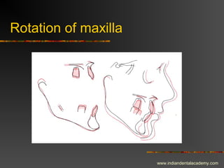 Development of occlusion /certified fixed orthodontic courses by Indian ...