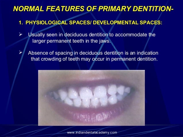 Development of primary dentition /certified fixed orthodontic courses…