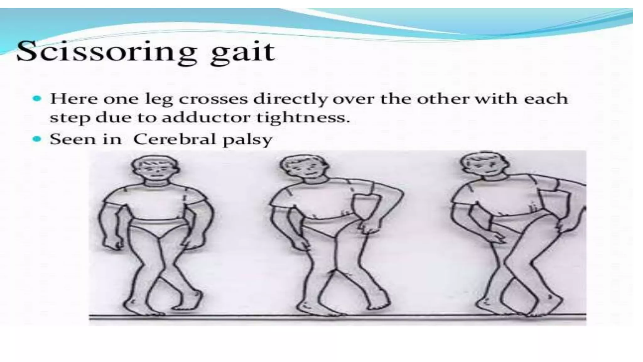 Localization And Control Of Gait And Posture Disorders Ppt