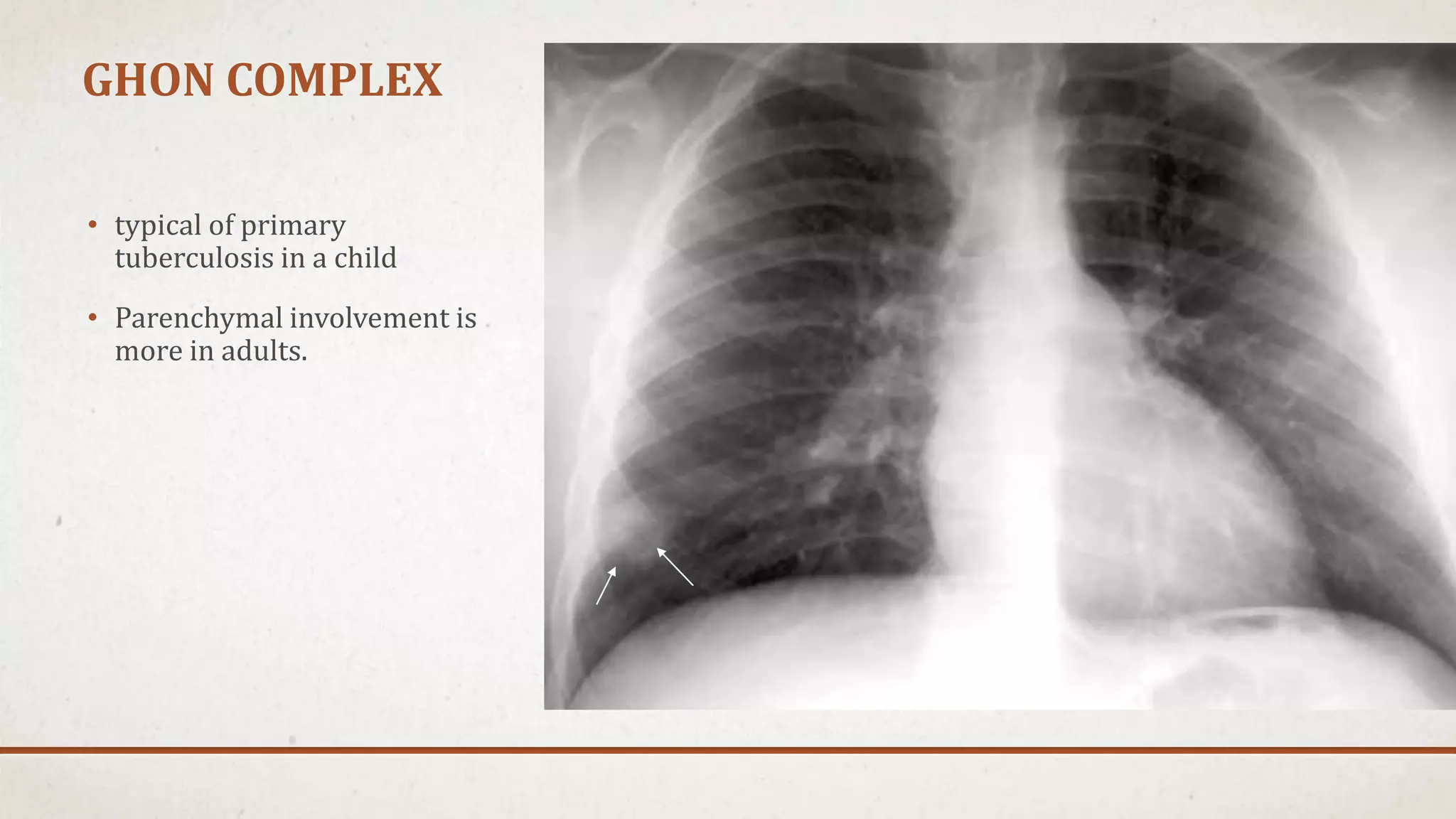 Radiographic manifestations of pulmonary tuberculosis | PPTX
