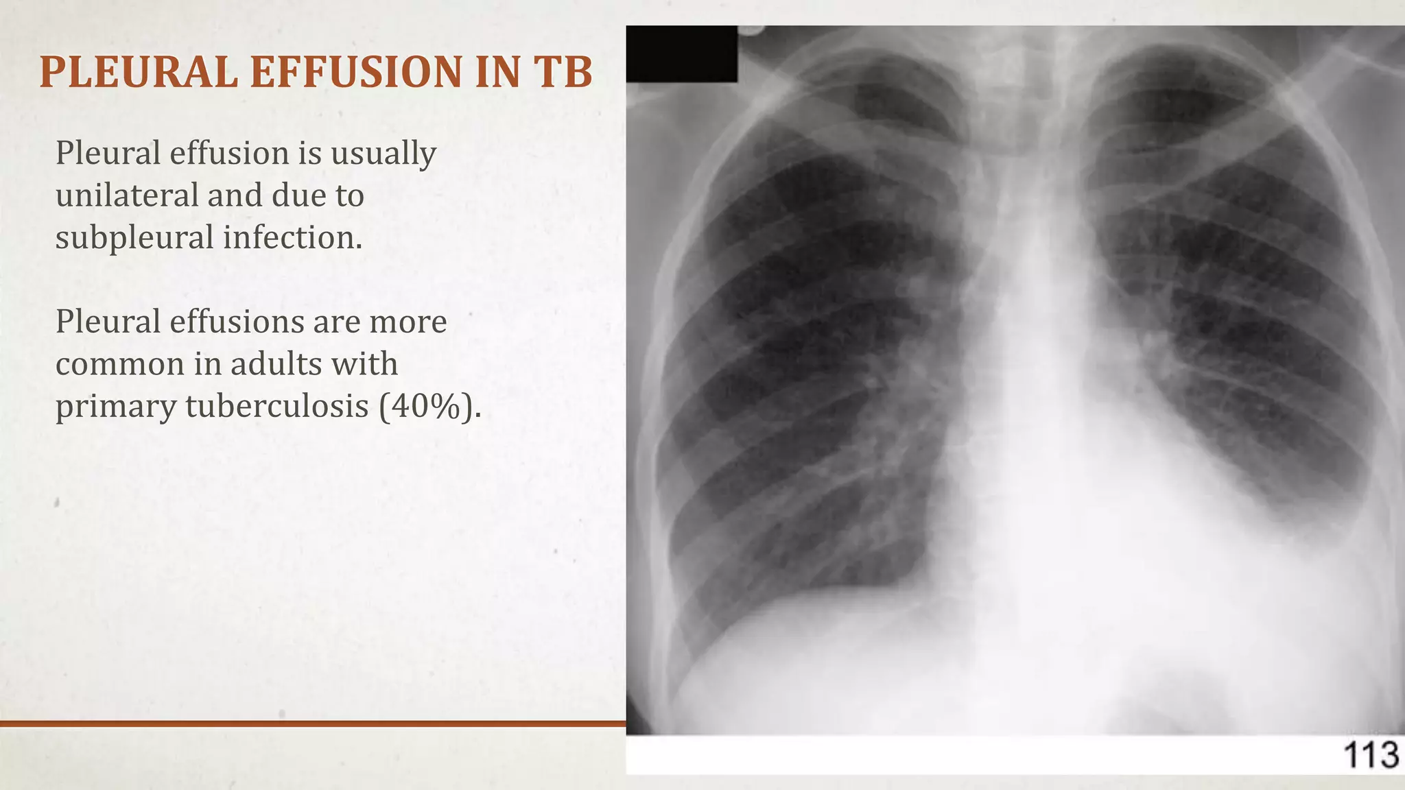 Radiographic manifestations of pulmonary tuberculosis | PPTX