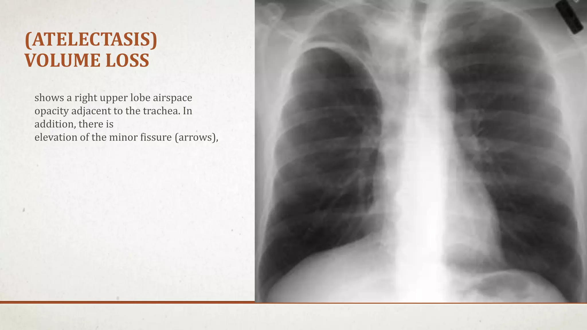 Radiographic manifestations of pulmonary tuberculosis | PPTX