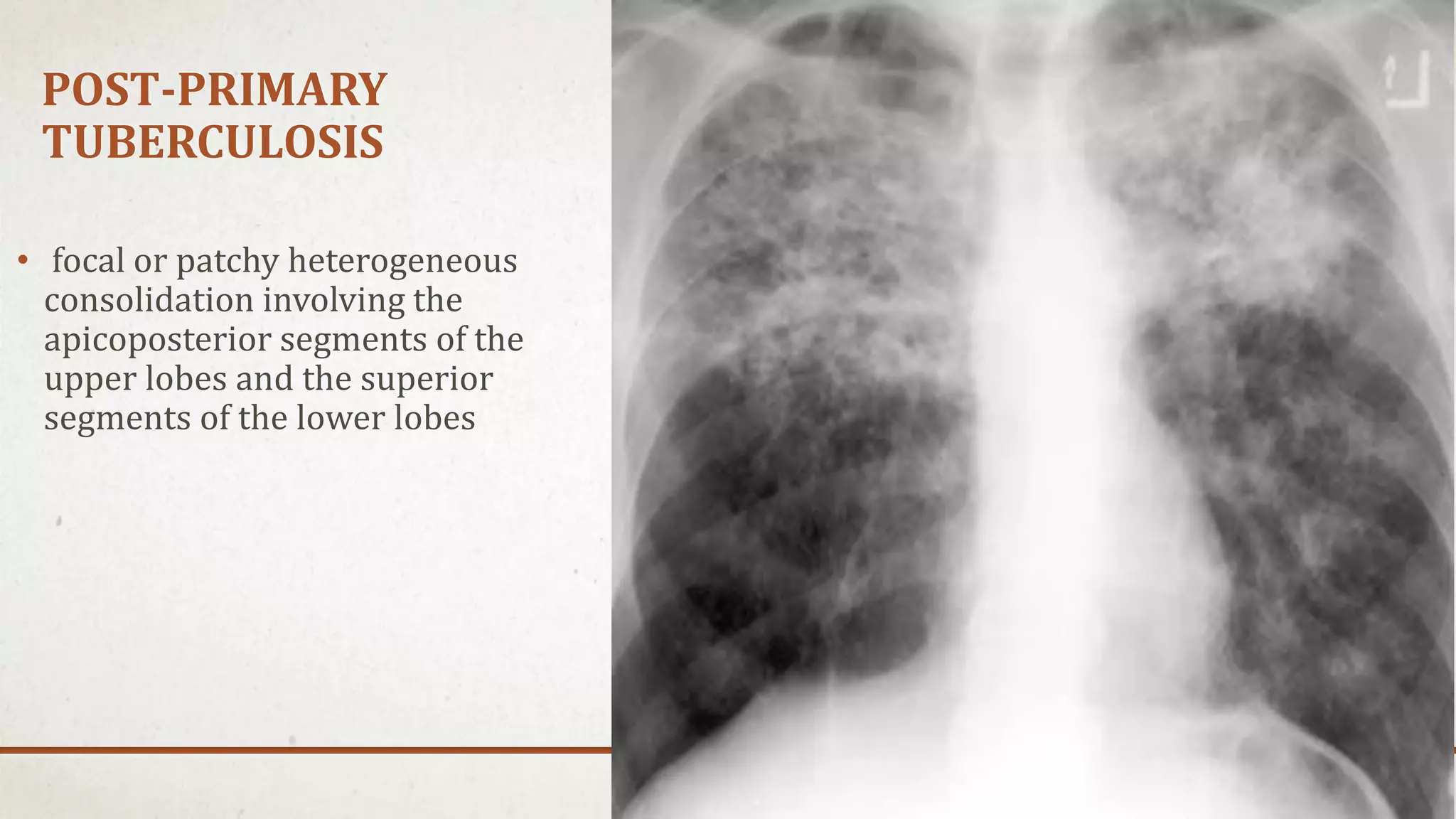 Radiographic manifestations of pulmonary tuberculosis | PPTX