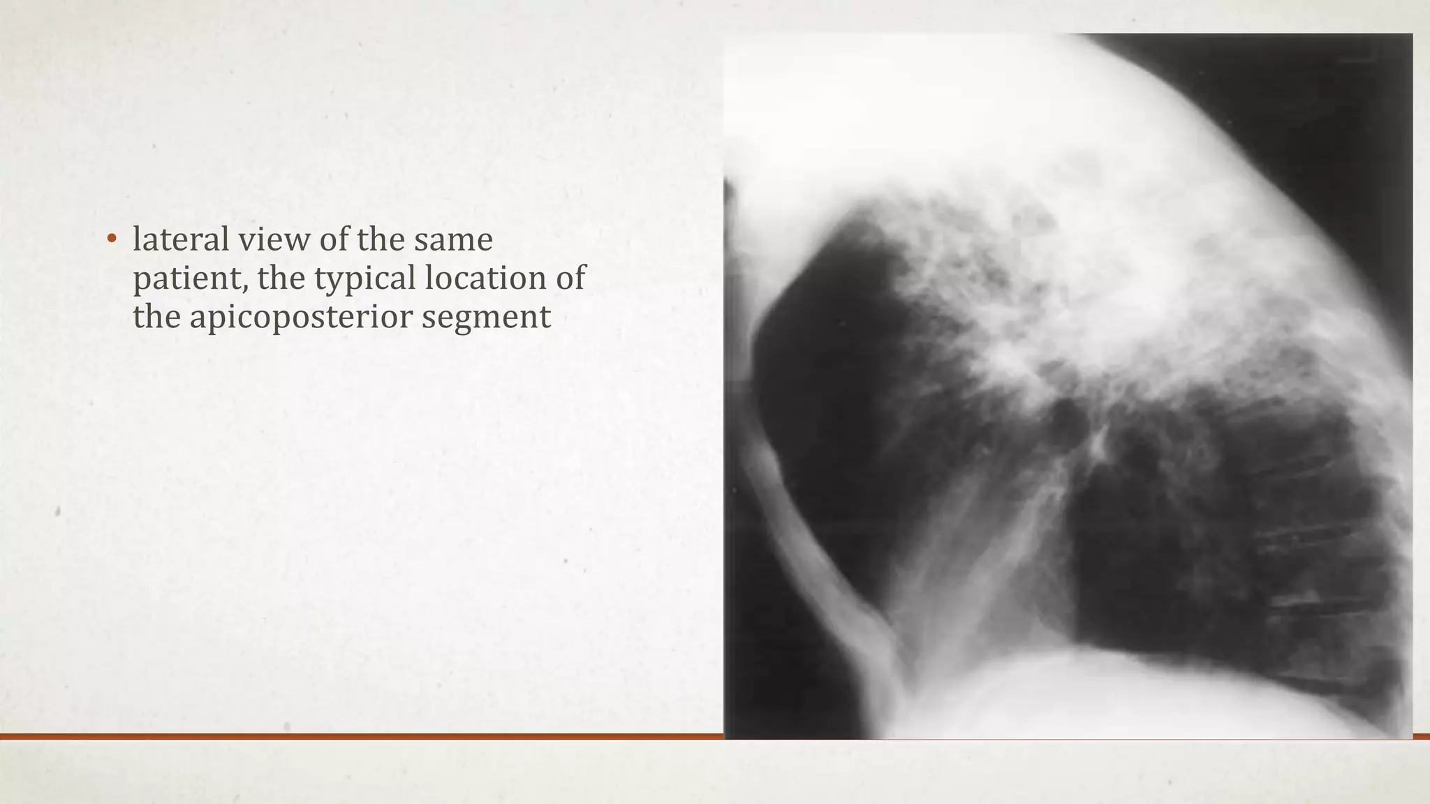 Radiographic manifestations of pulmonary tuberculosis | PPTX