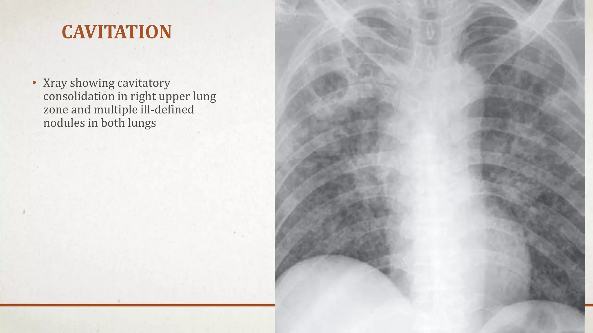 Radiographic manifestations of pulmonary tuberculosis | PPTX