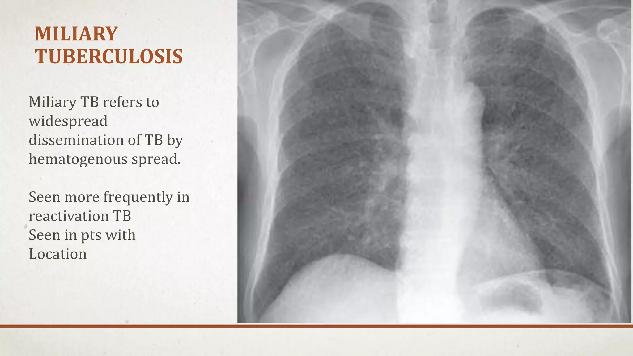 Radiographic manifestations of pulmonary tuberculosis | PPTX