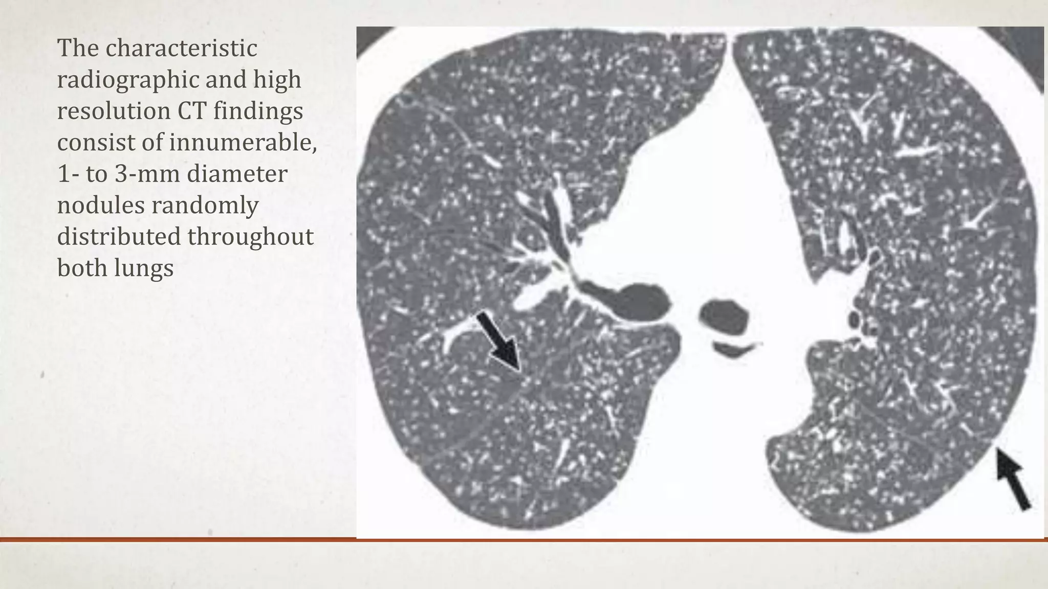 Radiographic manifestations of pulmonary tuberculosis | PPTX
