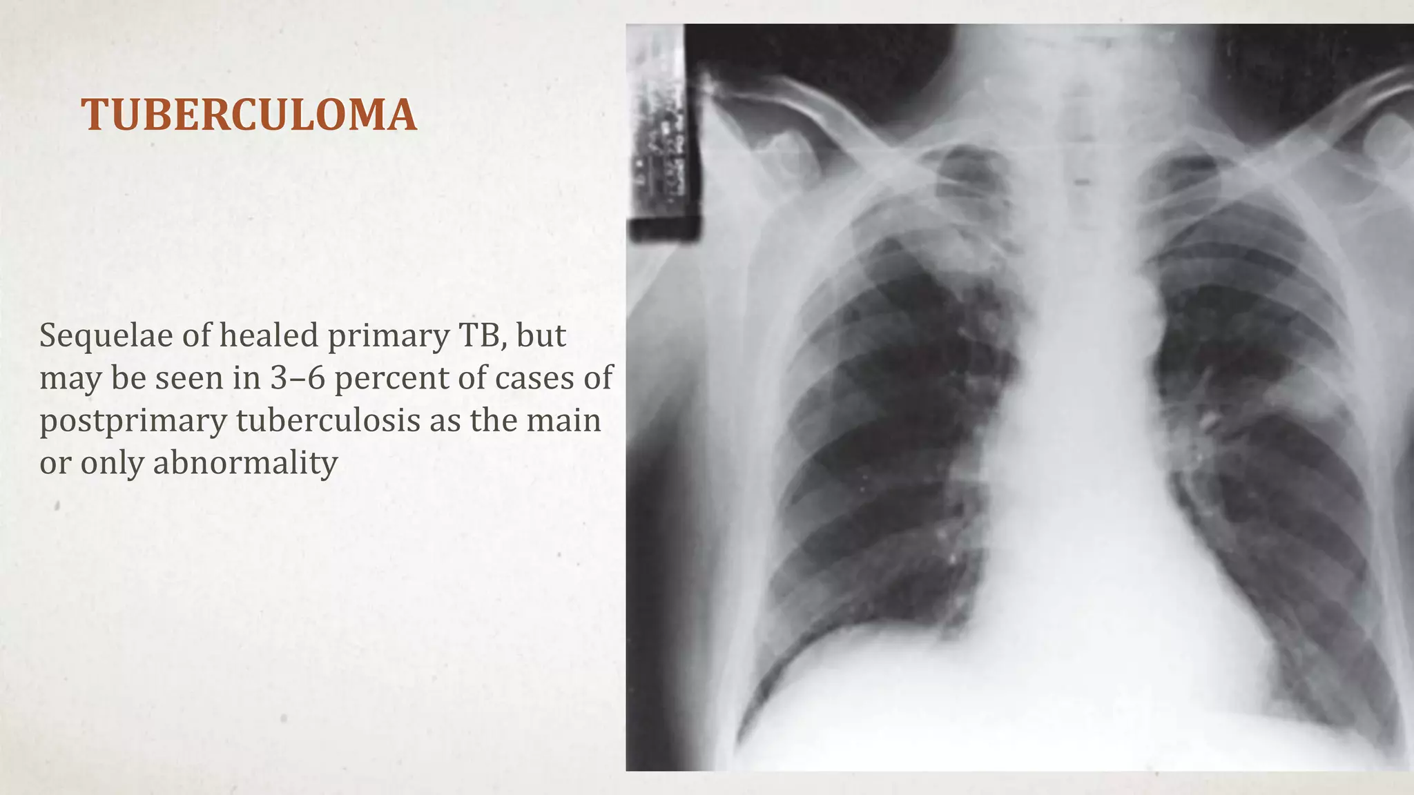 Radiographic manifestations of pulmonary tuberculosis | PPTX