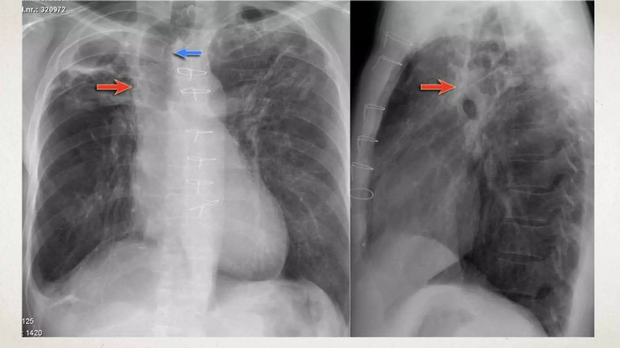 Radiographic manifestations of pulmonary tuberculosis | PPTX