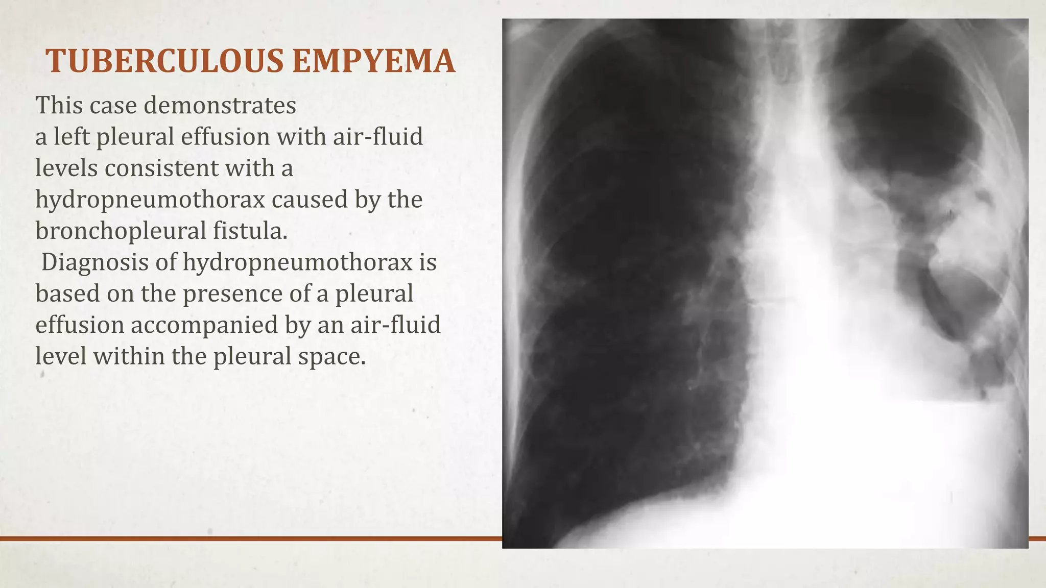 Radiographic manifestations of pulmonary tuberculosis | PPTX