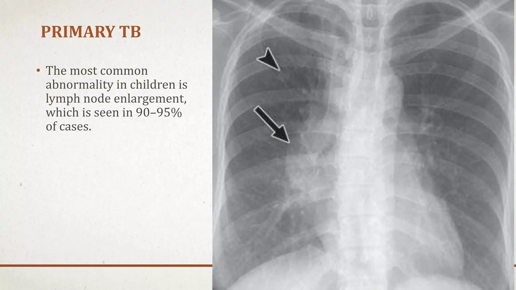 Radiographic manifestations of pulmonary tuberculosis | PPTX