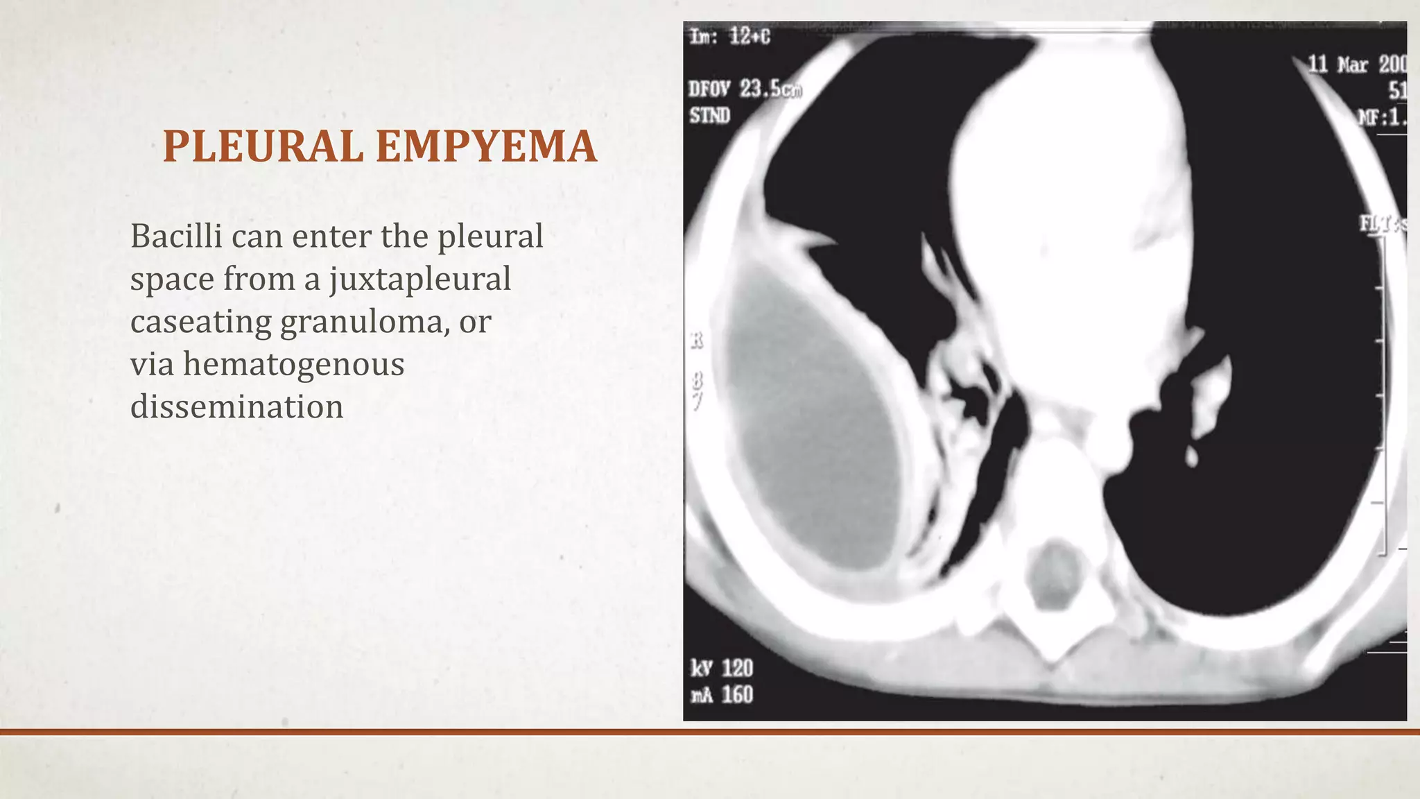 Radiographic manifestations of pulmonary tuberculosis | PPTX