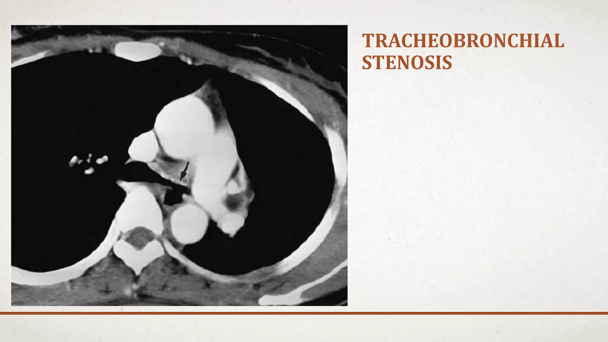 Radiographic manifestations of pulmonary tuberculosis | PPTX