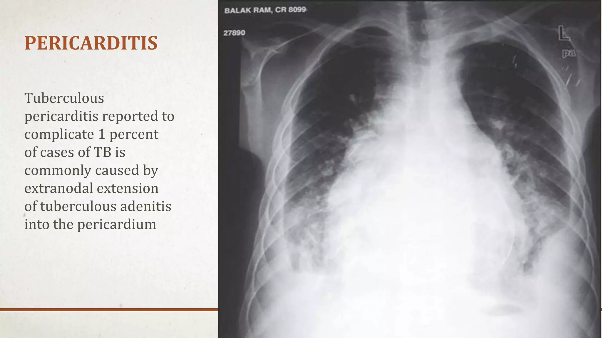 Radiographic manifestations of pulmonary tuberculosis | PPTX