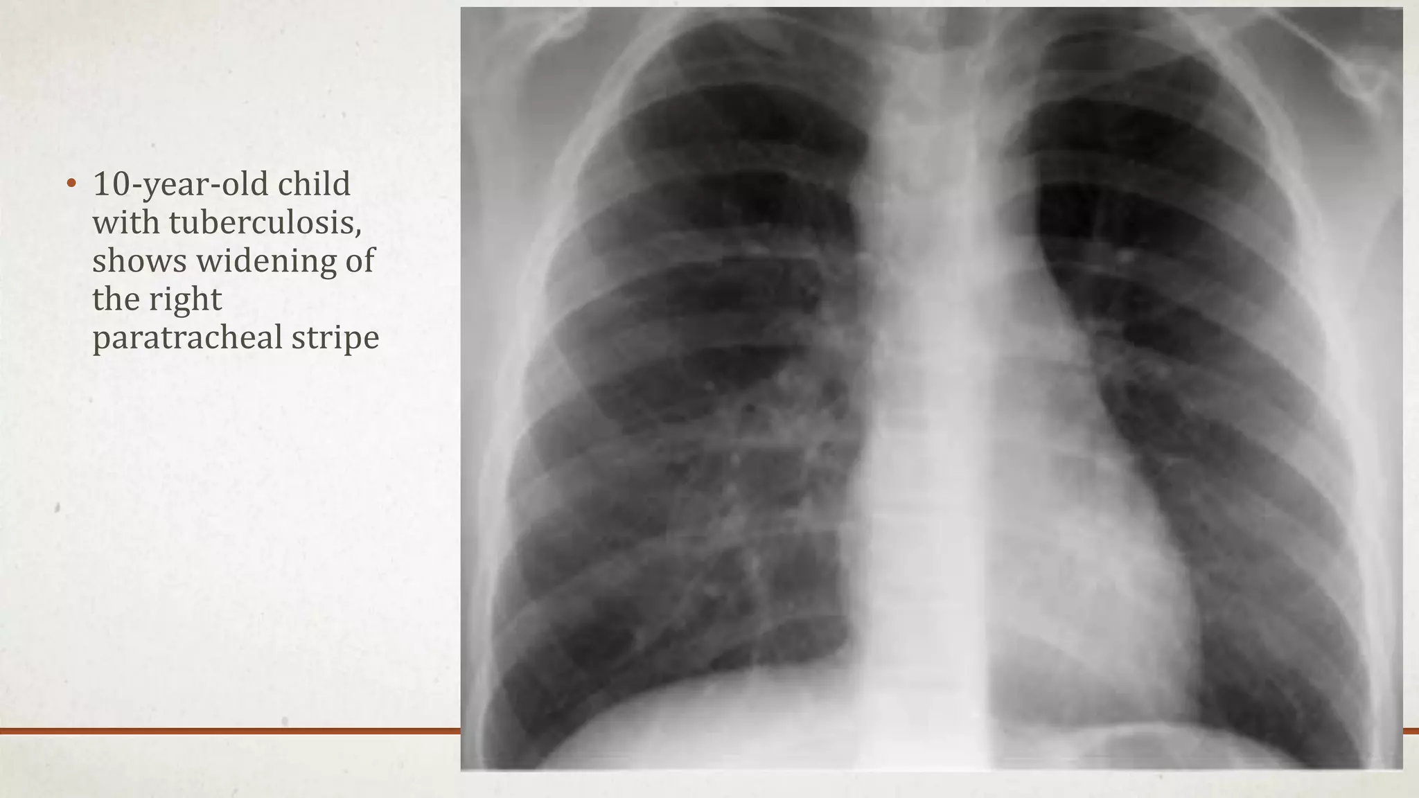 Radiographic manifestations of pulmonary tuberculosis | PPTX