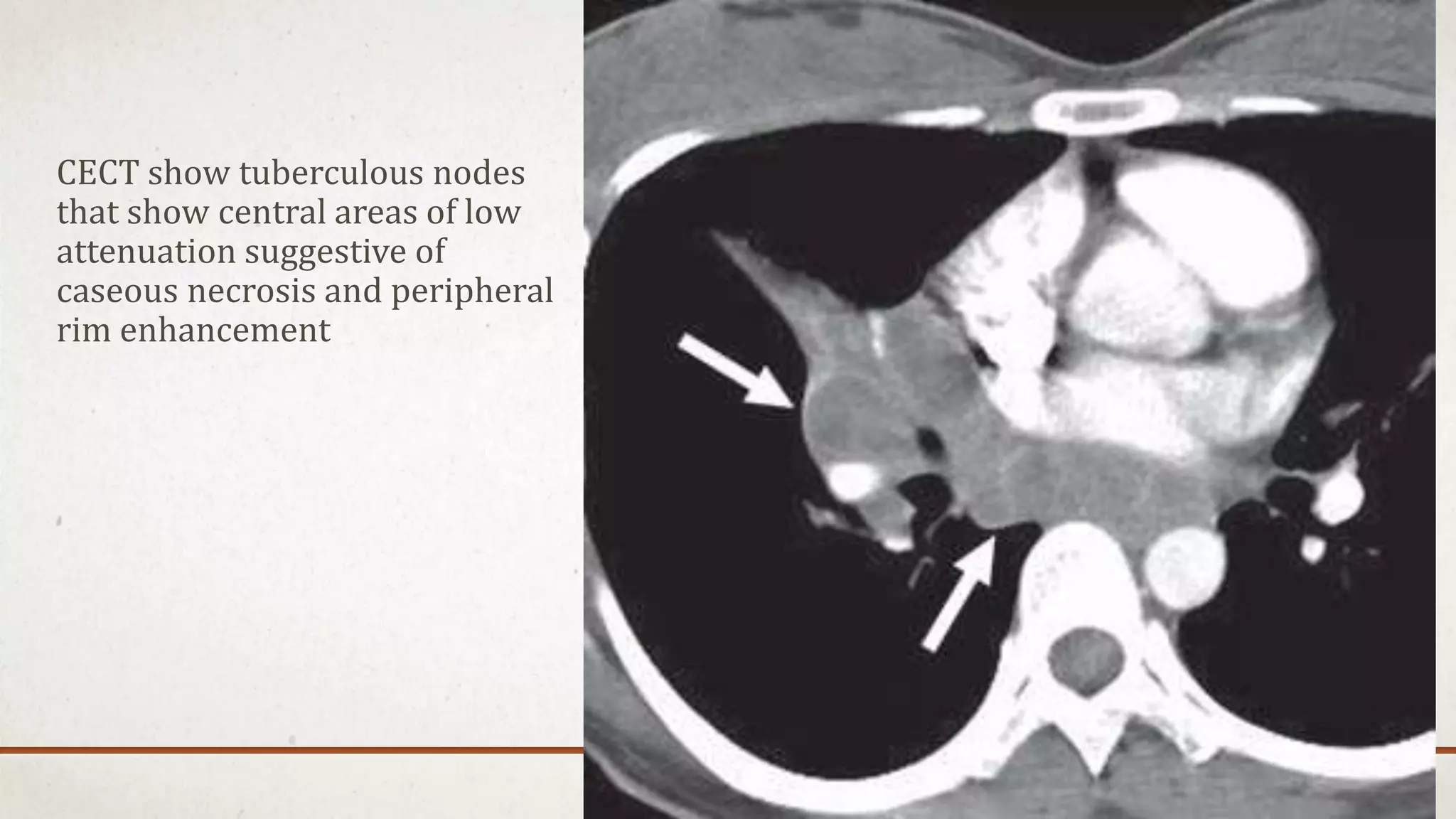 Radiographic manifestations of pulmonary tuberculosis | PPTX