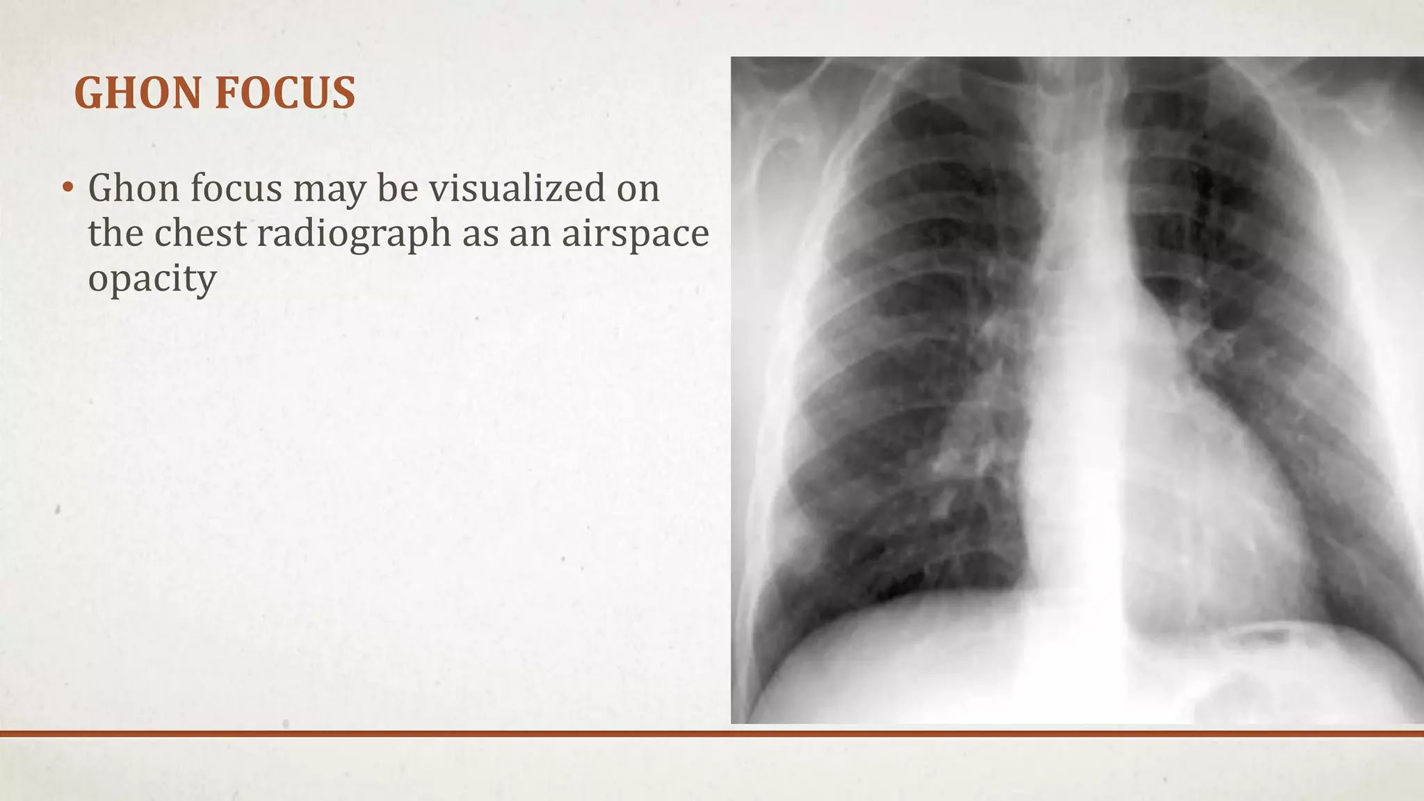 Radiographic manifestations of pulmonary tuberculosis | PPTX
