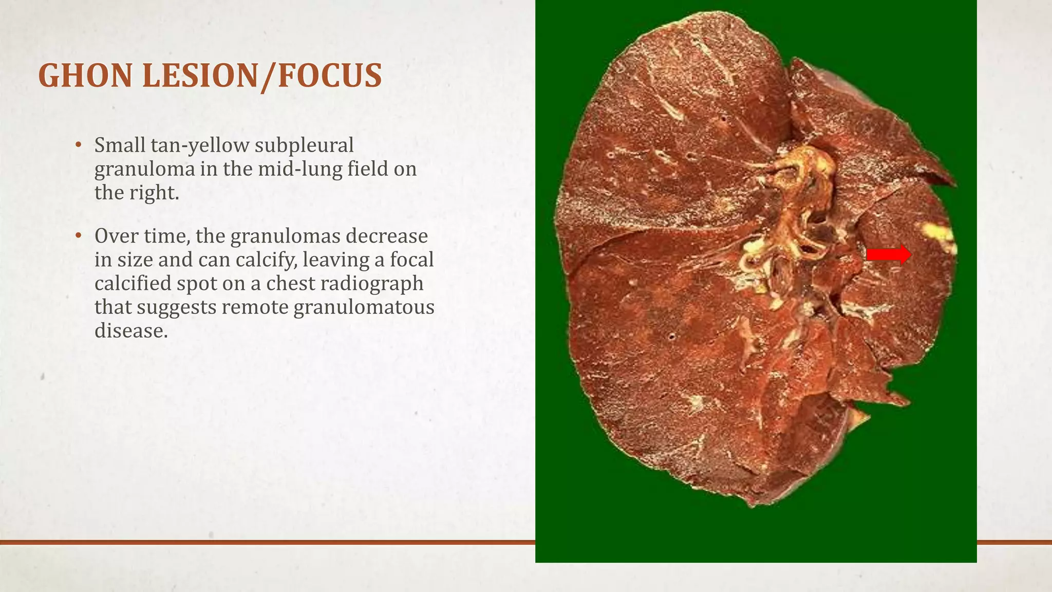 Radiographic manifestations of pulmonary tuberculosis | PPTX