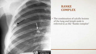 Radiographic manifestations of pulmonary tuberculosis | PPTX