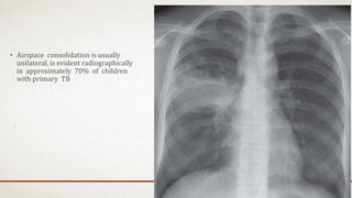 Radiographic manifestations of pulmonary tuberculosis | PPTX